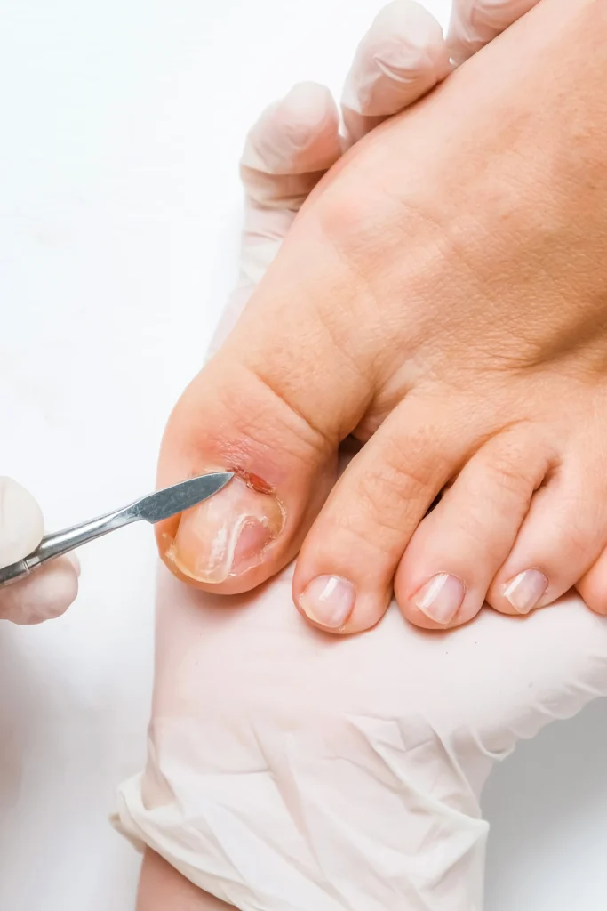 Fungal Nail Treatment - Feet First Newry