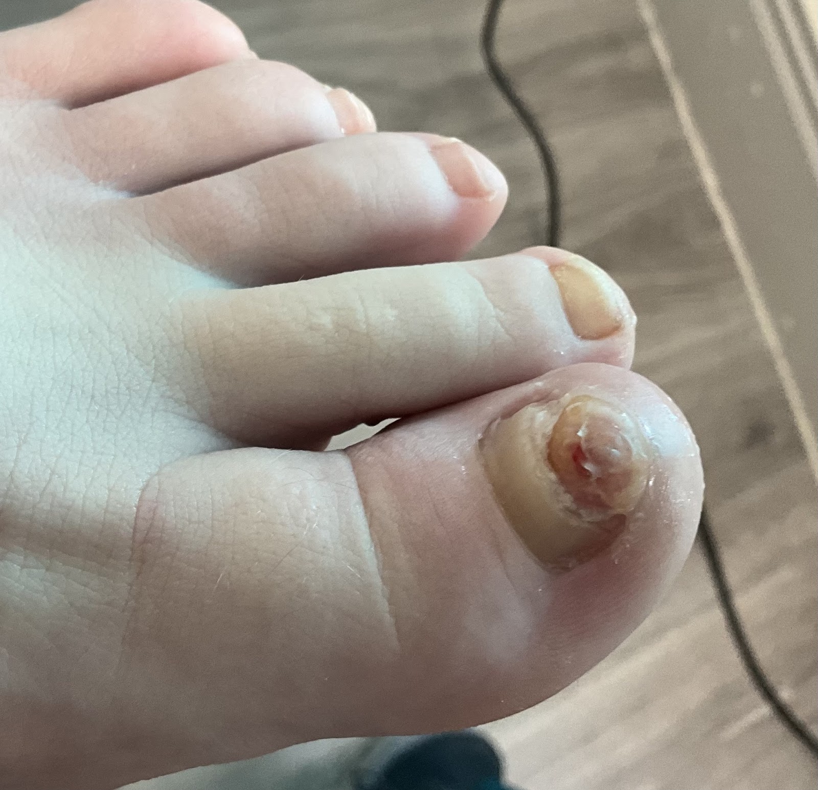 Patient Success Story! Subungal Exostosis - Feet First Newry